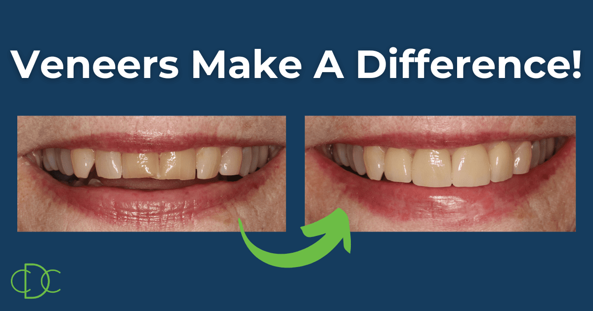 Before & After Veneers | Chesterfield, MI Dentist